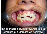 Clinica Dental: NORMAS DE OCLUSIÓN ESTATICA