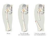 PRIMEROS AUXILIOS: ¿Qué es una Fractura?
