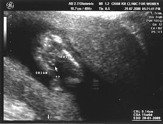 The Bub in the Belly: Scan at 14 weeks