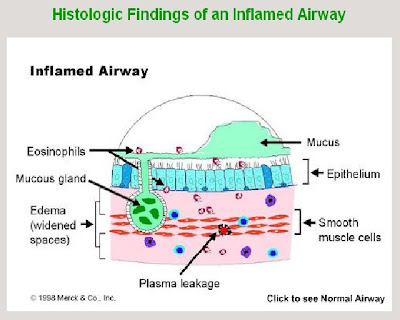 PBL Group A Website: Pathophysiology+signs and symptoms of asthma