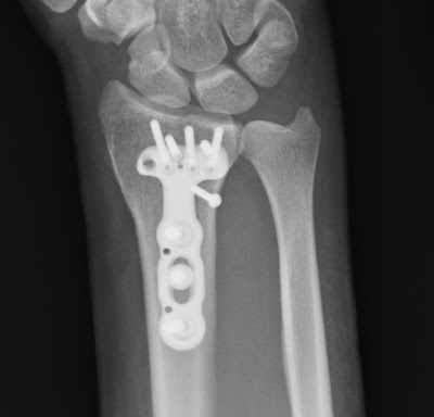 Walks with Moss: dvr plate pictures of my bionic wrist