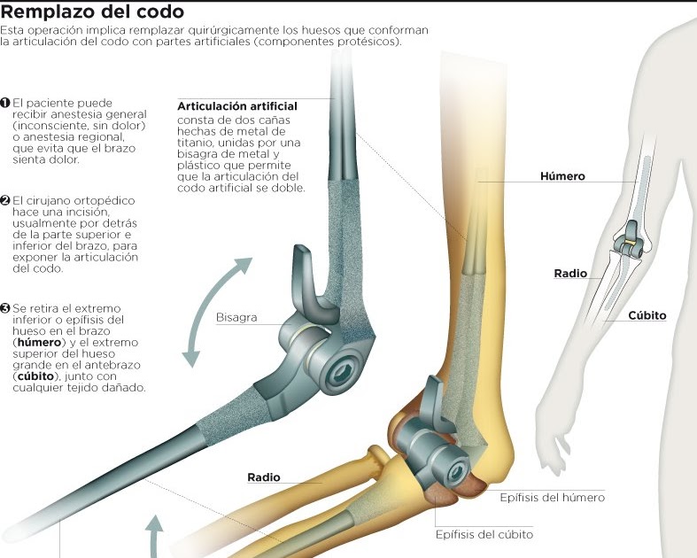 Infográfica: Remplazo de codo