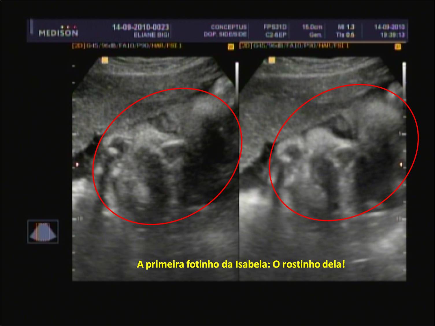 A incrível aventura de sermos pais: Ultrassom Obstétrico