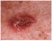 back To Nature: SKIN CANCER