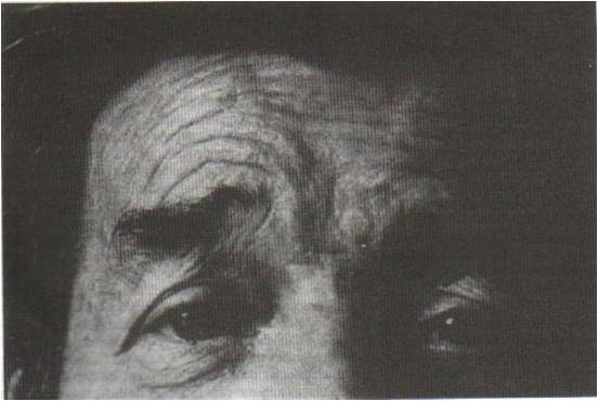 Depresion: Fascies de la omega melancolica en la depresion