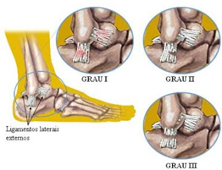 ARTIGOS: ENTORSES DE TORNOZELO