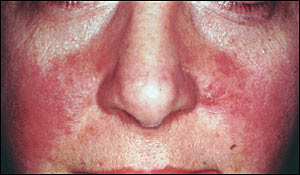 rosacea