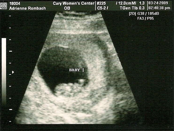 Segue: Ultrasound pictures at 9 weeks