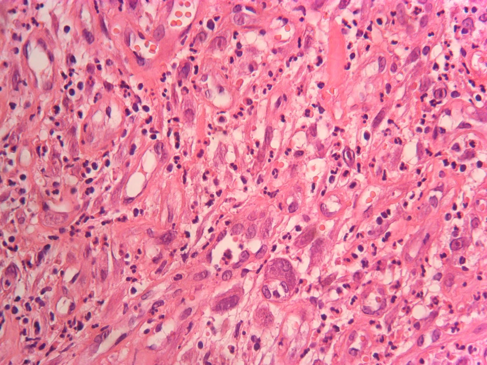 Células Estromais; Células do Estroma; Células Estromáticas