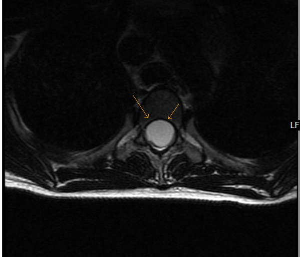 Spinal Intradural Arachnoid Cyst Mri Sumers Radiology Blog