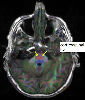 Diffusion Tensor Imaging-Anatomy - Sumer's Radiology Blog