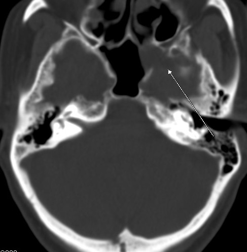 Nontraumatic Skull Base Defect with CSF Rhinorrhea - Sumer's Radiology Blog