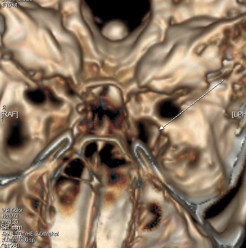 Nontraumatic Skull Base Defect with CSF Rhinorrhea - Sumer's Radiology Blog