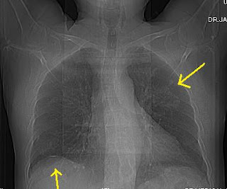Asbestos Exposure-CT - Sumer's Radiology Blog