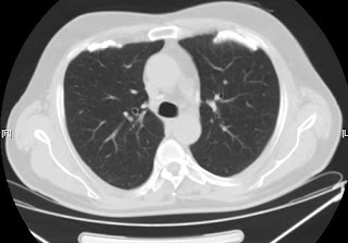 Asbestos Exposure-CT - Sumer's Radiology Blog