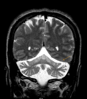 OLIVOPONTOCEREBELLAR ATROPHY-MRI - Sumer's Radiology Blog