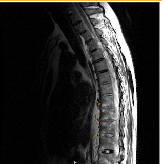 ANKYLOSING SPONDYLITIS-MRI - Sumer's Radiology Blog