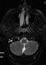 Glomus Tympaniucm-MRI &CT - Sumer's Radiology Blog