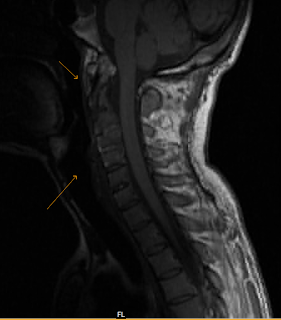 Craniovertebral Junction Involvement In Ankylosing Spondylitis-MRI ...