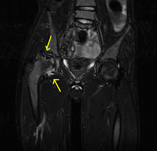 Legg-Calvé-Perthes disease-MRI - Sumer's Radiology Blog