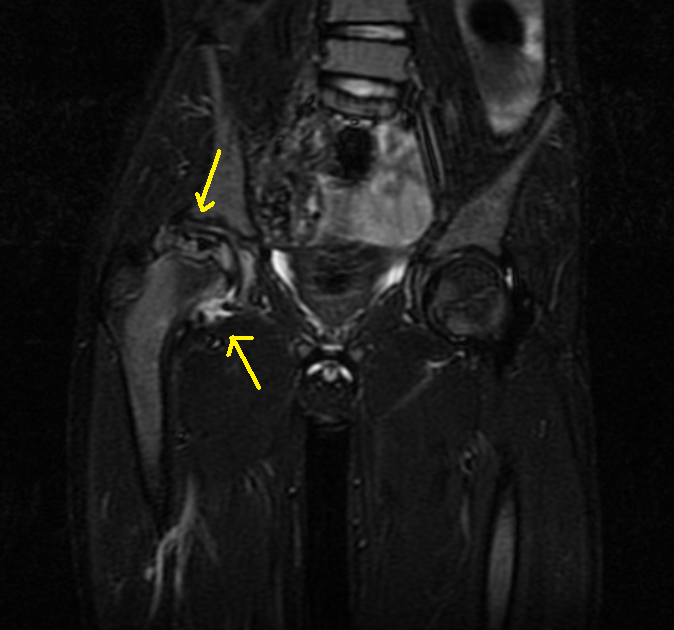 legg-calv-perthes-disease-mri-sumer-s-radiology-blog