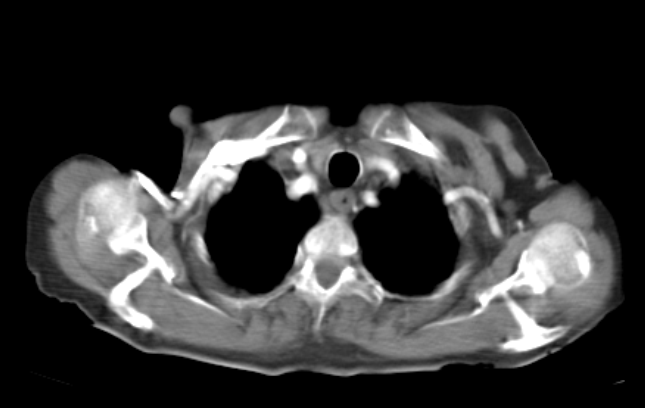 Poland's Syndrome-CT - Sumer's Radiology Blog