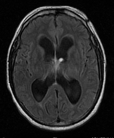 Normal Pressure Hydrocephalus-MRI - Sumer's Radiology Blog