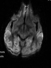 Creutzfeldt–Jakob disease-MRI - Sumer's Radiology Blog