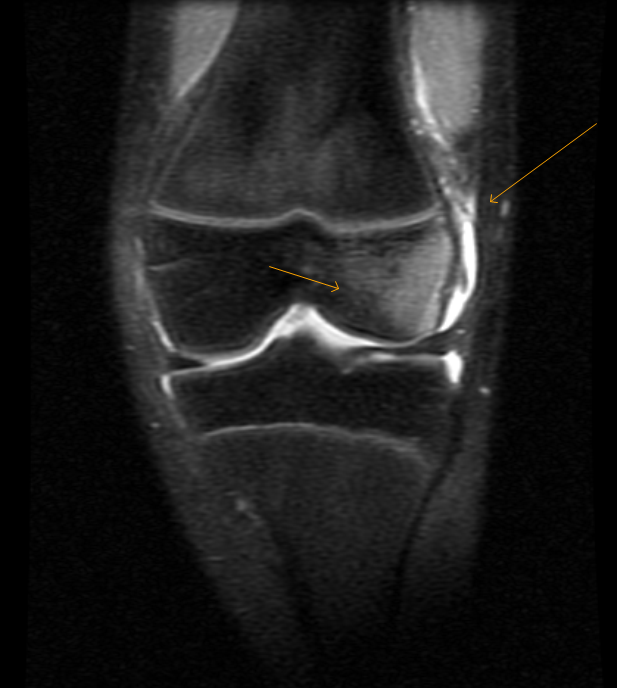 Acute Lateral Patellar Dislocation-MRI - Sumer's Radiology Blog