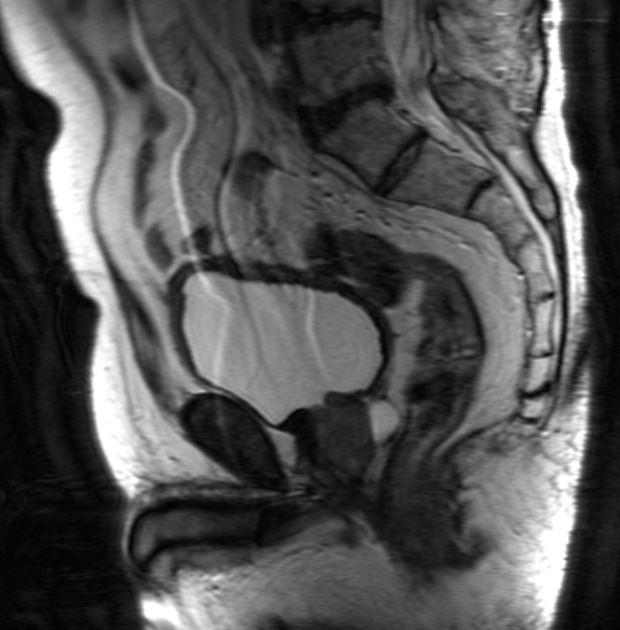 Müllerian Duct Cysts and Prostatic Utricle Cysts - Sumer's Radiology Blog