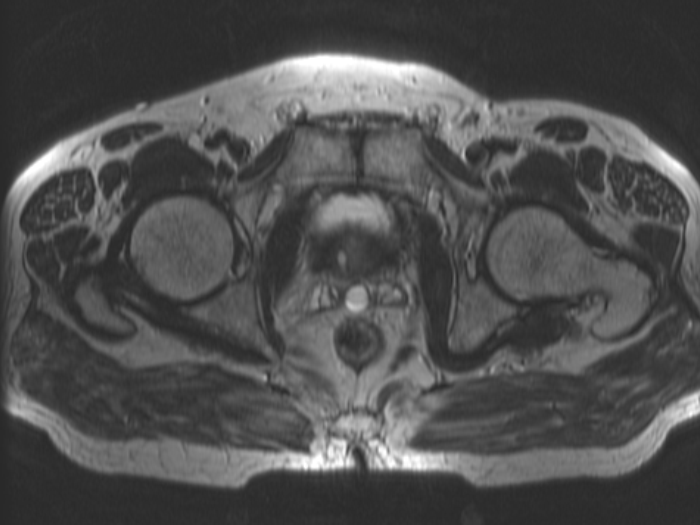 Müllerian Duct Cysts and Prostatic Utricle Cysts - Sumer's Radiology Blog