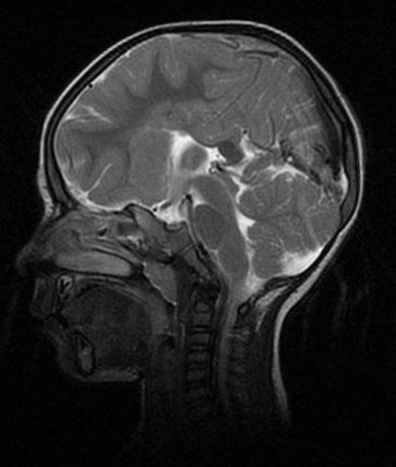 Holoprosencephaly - MRI - Sumer's Radiology Blog