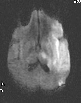 Hyperdense MCA sign-Hyperacute Stroke - Sumer's Radiology Blog