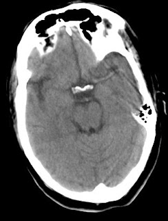 Hyperdense MCA sign-Hyperacute Stroke - Sumer's Radiology Blog