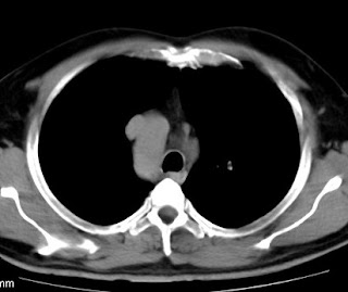 Right Sided Aortic Arch - Sumer's Radiology Blog