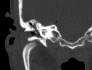 Temporal Bone Fracture-CT - Sumer's Radiology Blog