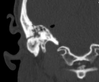 Temporal Bone Fracture-CT - Sumer's Radiology Blog