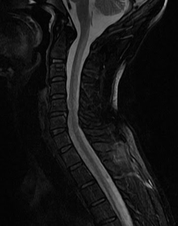 Sub-acute combined degeneration-MRI - Sumer's Radiology Blog