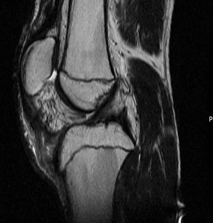 Patellar Tendon Injury-MRI - Sumer's Radiology Blog