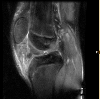 Patellar Tendon Injury-MRI - Sumer's Radiology Blog