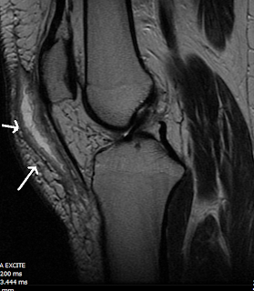 Housemaid's Knee-MRI - Sumer's Radiology Blog