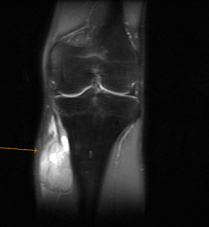 Medial collateral ligament injury with bursitis-MRI - Sumer's Radiology ...