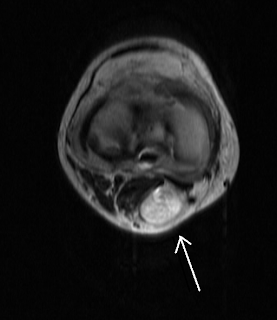 Giant Baker's Cyst-MRI - Sumer's Radiology Blog