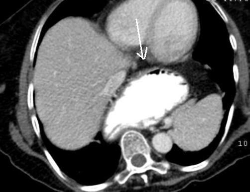 Giant hiatal hernia-CT - Sumer's Radiology Blog