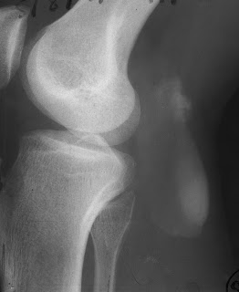 Calcified Baker's Cyst - Sumer's Radiology Blog