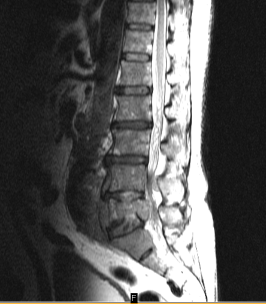 Spinal metastasis-MRI - Sumer's Radiology Blog