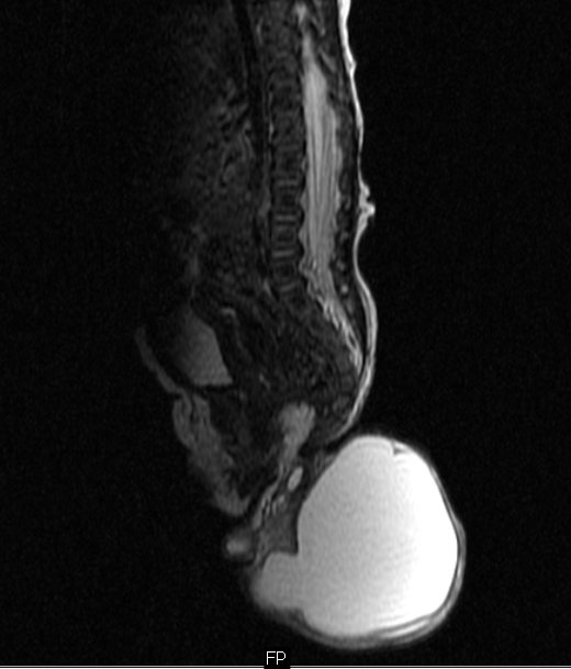 SACROCOCCYGEAL TERATOMA - Sumer's Radiology Blog