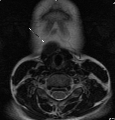 Ectopic Thyroid-MRI - Sumer's Radiology Blog
