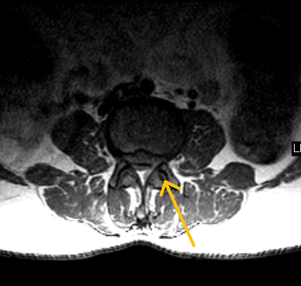 Rare Posterior Epidural Disk Sequestration-MRI - Sumer's Radiology Blog
