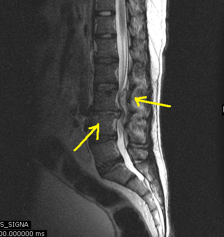 Rare Posterior Epidural Disk Sequestration-MRI - Sumer's Radiology Blog
